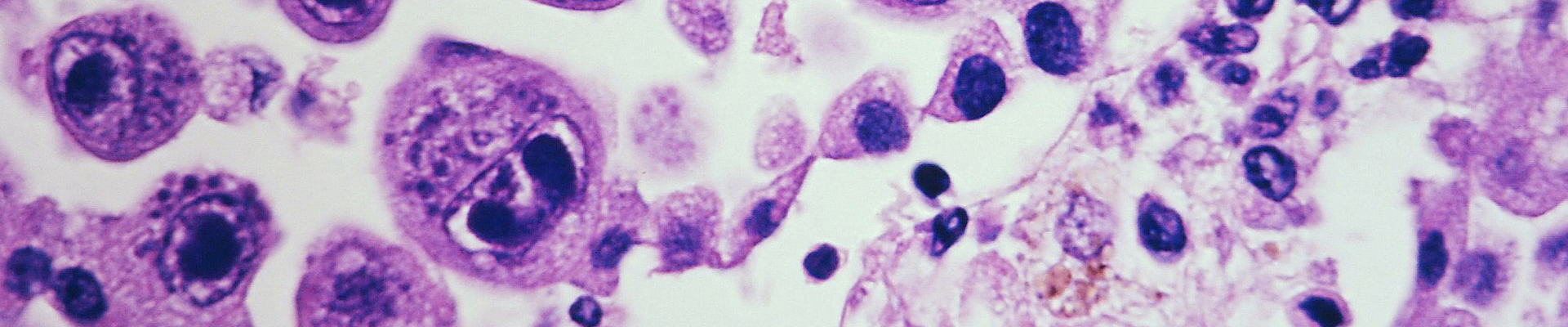 Cytomégalovirus et grossesse : une équipe toulousaine décrypte un mécanisme viral favorisant l ...